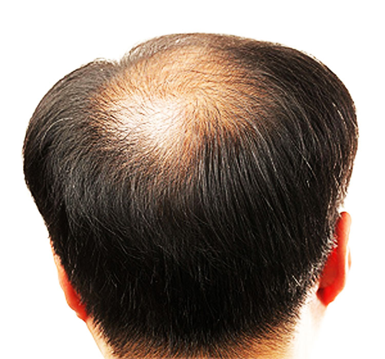 Calvicie - Un paso más hacia un tratamiento efectivo